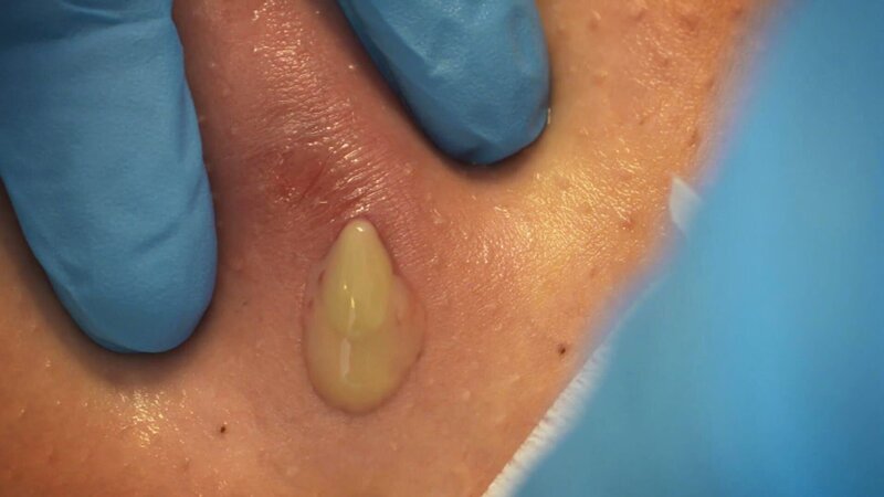 Hautnah S01E01: Pickel, Pusteln und Lipome (Episode 1) – fernsehserien.de